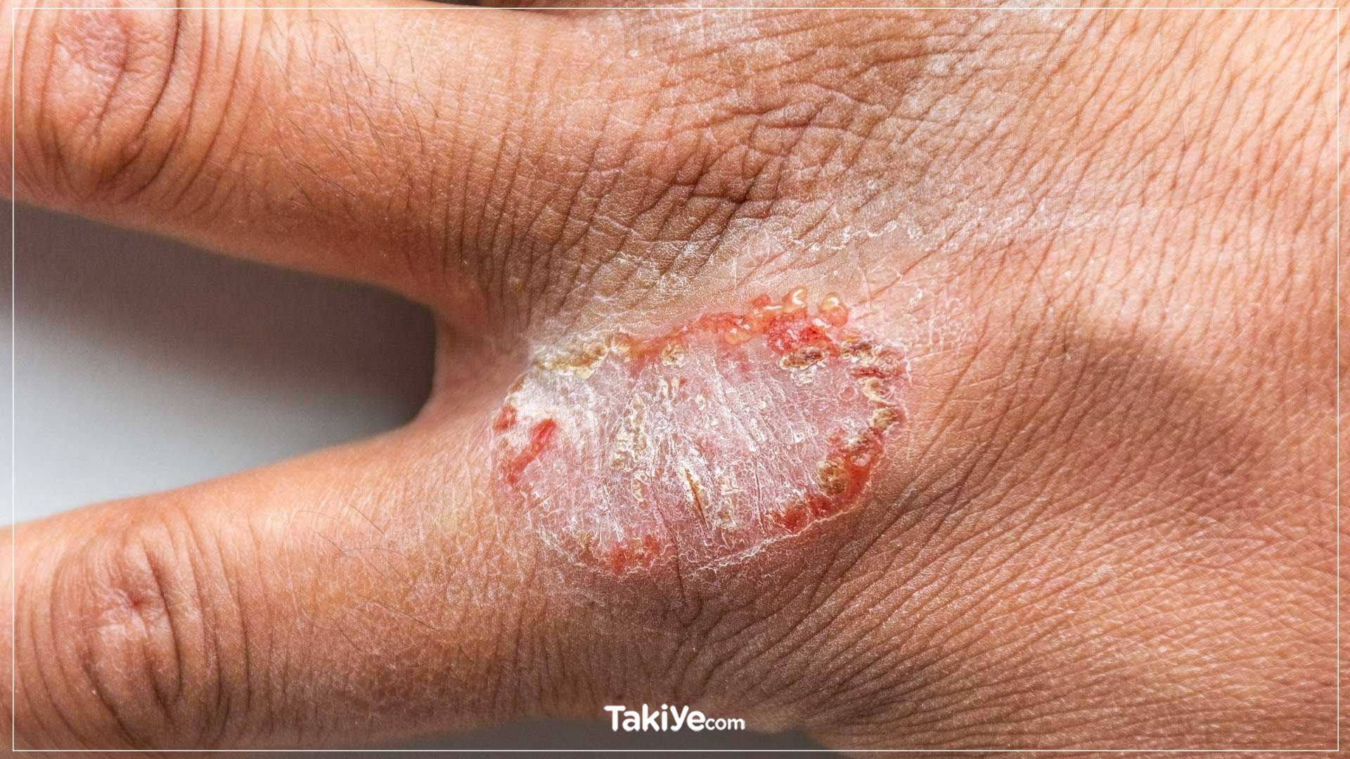 Sedef Hastalığı Nedir, Belirtileri, Neden Olur, Bulaşıcı mı? - Takiye.com